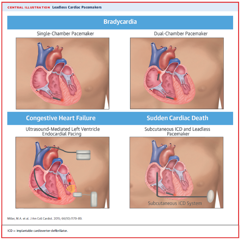 Permanent Leadless Cardiac Pacing - American College of Cardiology